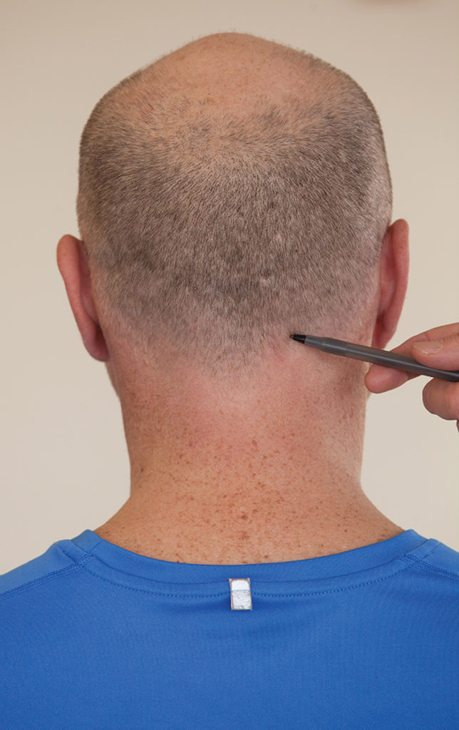 Gall Bladder 20 Point for Headache Relief - Calming the Headache Storm